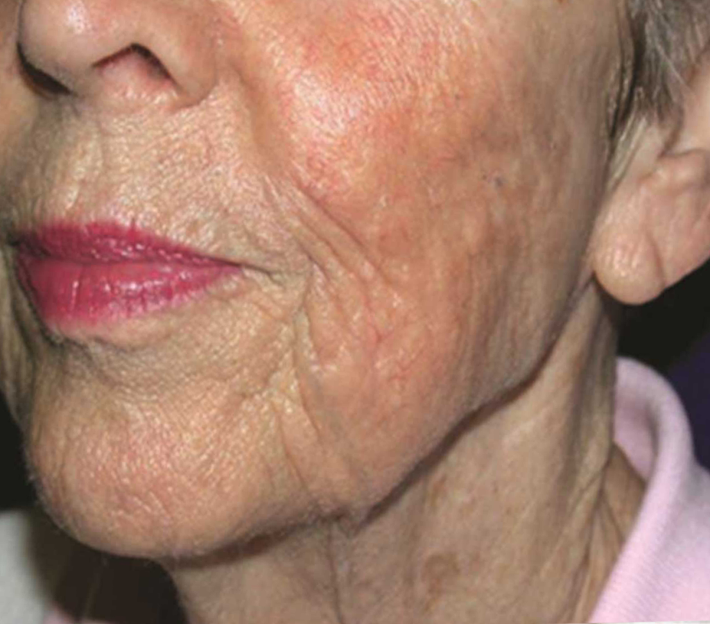 Pigment and Vascular Lesions | The Laser Beautique