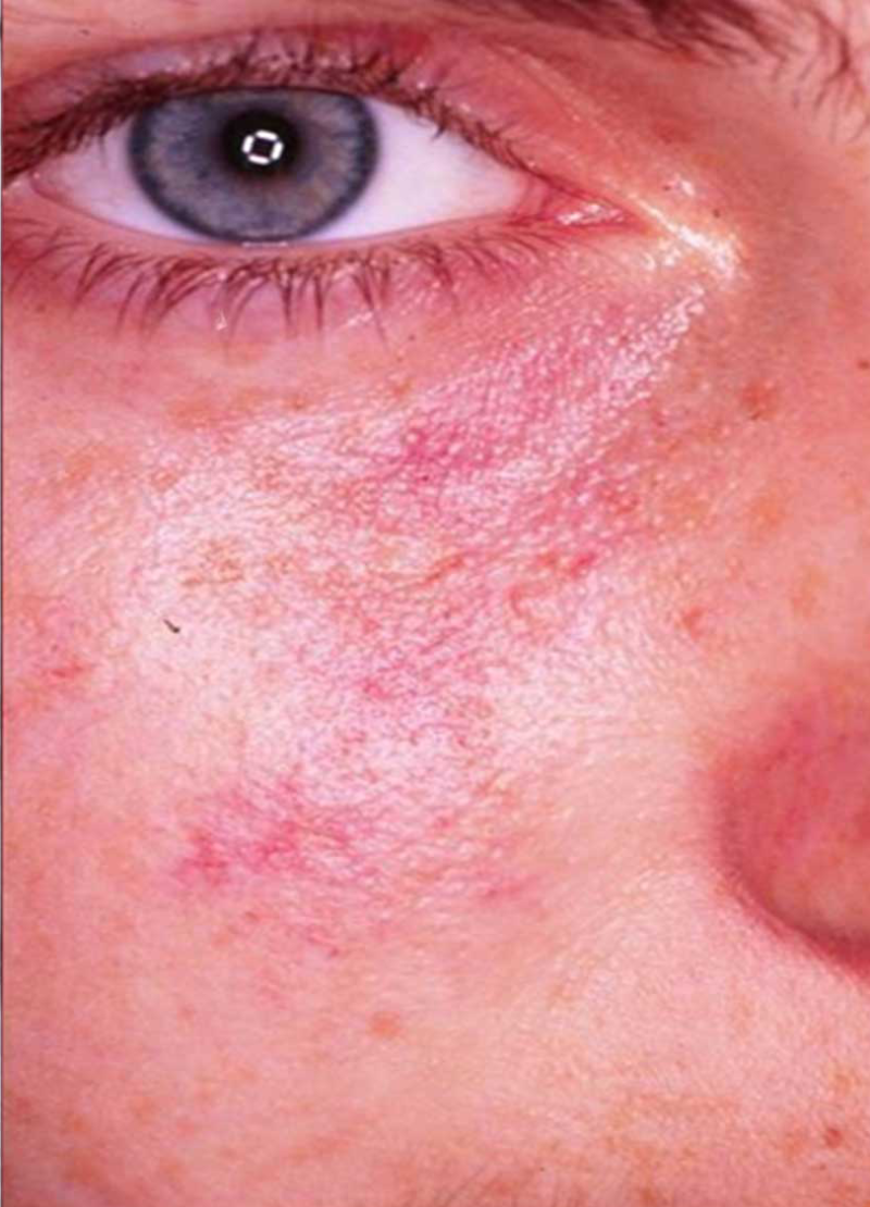 Pigment and Vascular Lesions | The Laser Beautique
