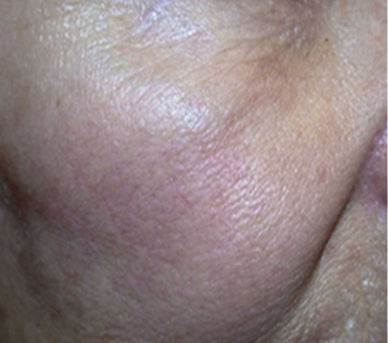 Pigment and Vascular Lesions | The Laser Beautique
