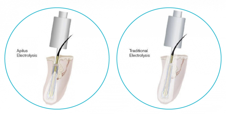 Electrolysis Reinvented | 100% Permanent Hair Removal | The Laser Beautique